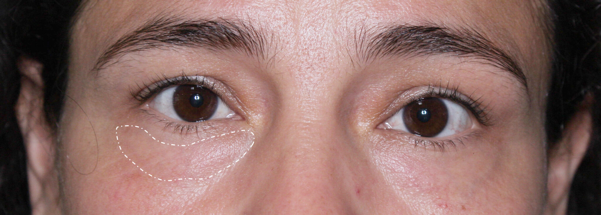 Blefaroplastia Cirugía Párpados Dr Juan Sebastián Morales